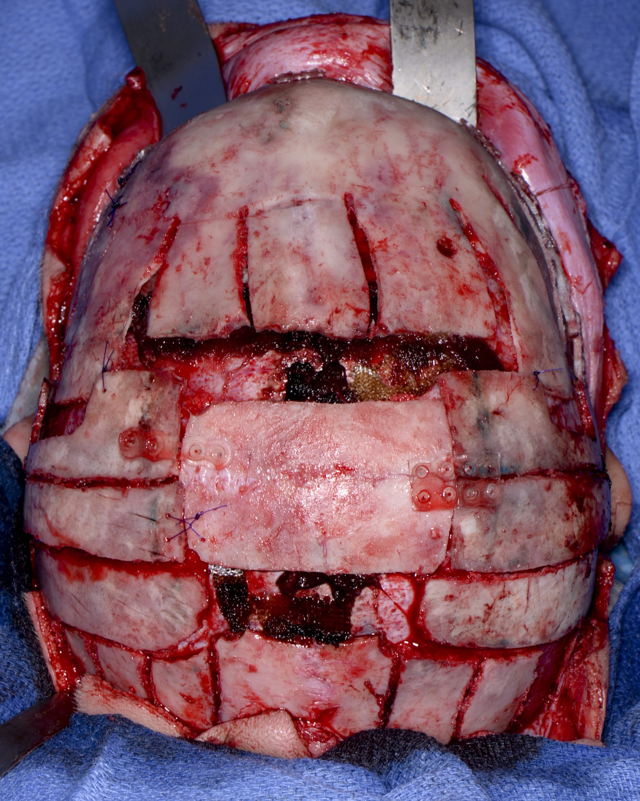 Paediatric Cranial Vault Expansion